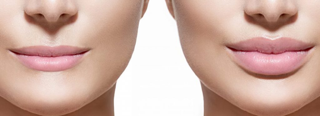 es types de lipofilling pour un corps et un visage parfaits
